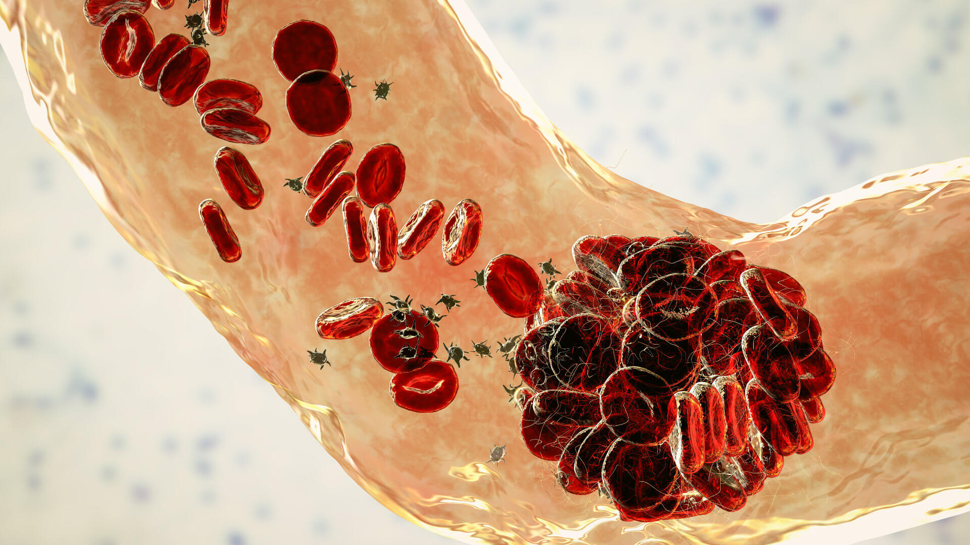 Pulmonary Embolism | Physicians Vein Clinics Physicians Vein Clinics
